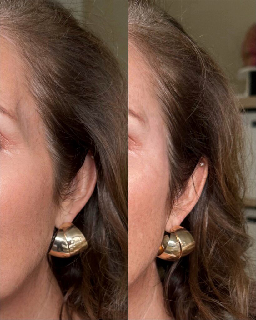 Temple Filler - M&K Aesthetics